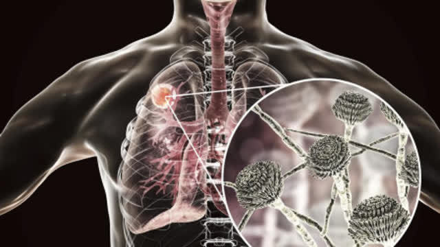 肺结核是如何传播的?医生直言:想要预防肺结核,做好3件事