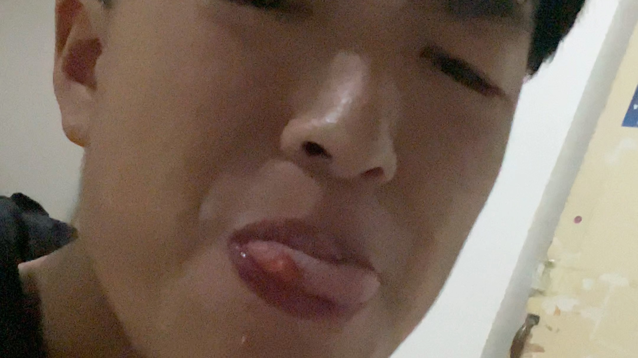 舌 头 的 痛!