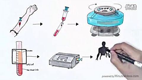 PRP高浓度血小板血浆简介