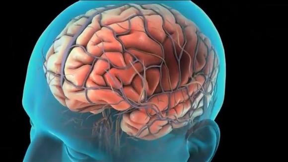 3D动画模拟--心房颤动(房颤)形成血栓是如何导致脑梗塞的?