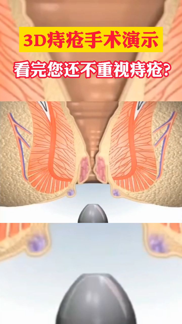 3D痔疮手术演示,看完您还不重视痔疮?