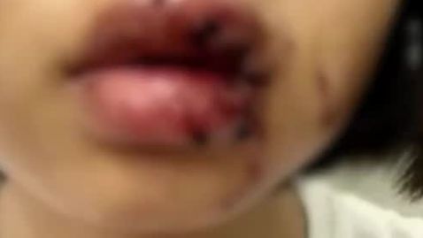 女孩被狗咬伤索赔6.8万 狗主人:无法接受