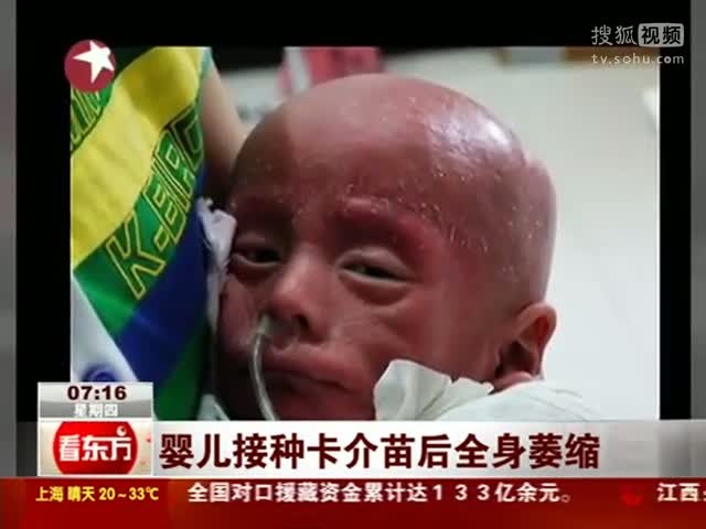 婴儿接种卡介苗后全身微缩医治无望