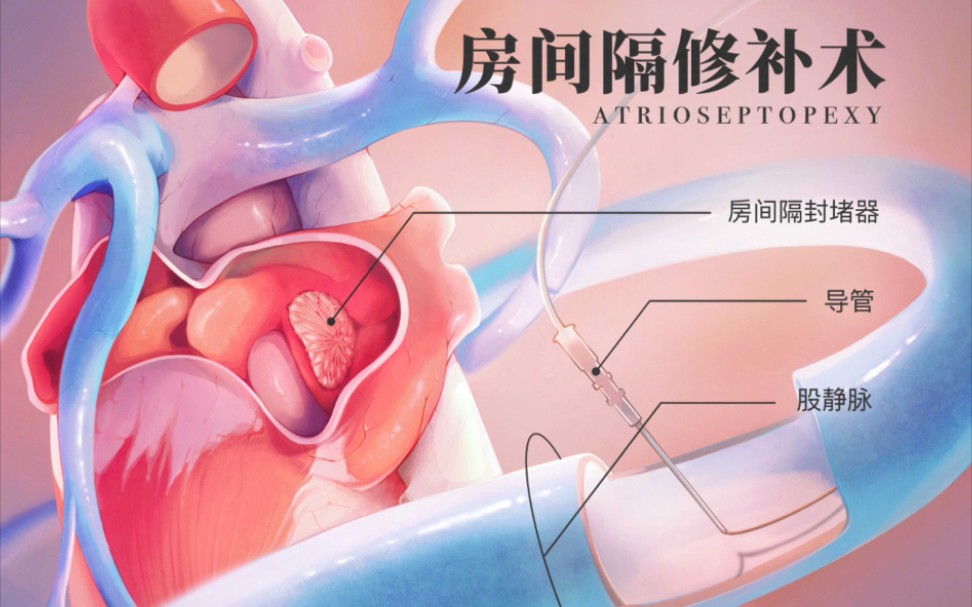 【爱MU杯医学插画作品】房间隔缺损修补术绘制过程
