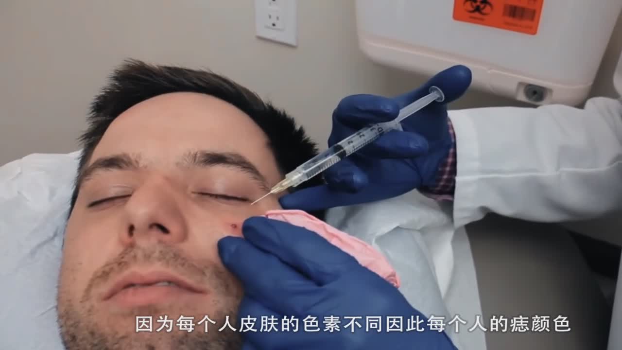 去痣手术是如何做的? 3D动画演示全过程,看完你害怕了吗?