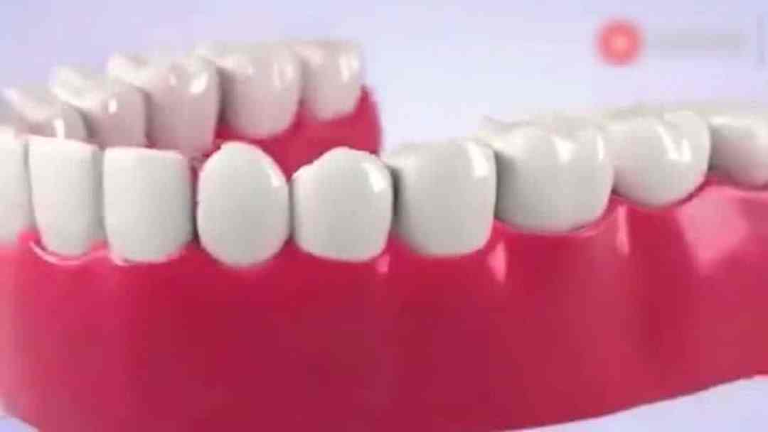 【3D模拟】3分钟看完牙齿种植、牙齿矫正、补牙、根管治疗.