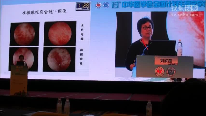 中华医学会第十三次全国计划生育学学术会议宫腔直视人流手术研究