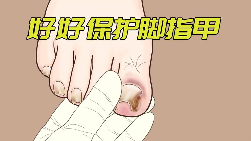 脚指甲微型手术,看完感觉自己脚麻了,务必要保护好脚指甲!