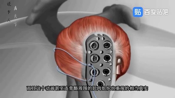 3D动画模拟骨折修复手术,隔着屏幕都瑟瑟发抖
