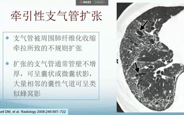 8.支气管扩张的CT诊断-影像诊断思维训练营系列1