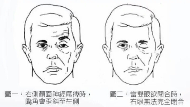 挤眉眨眼,不自主抽动