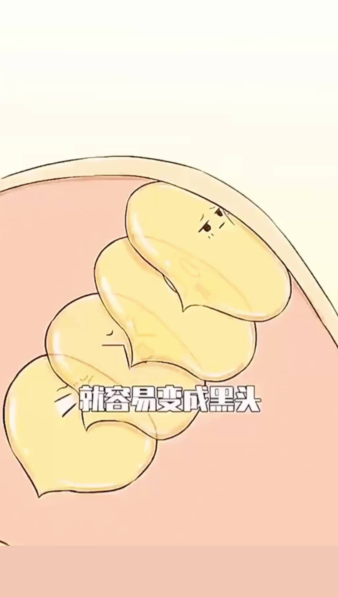 拜托,别再用手挤啦,越挤毛,孔越大!#壬二酸#水杨酸#拒绝草莓鼻(￣﹏￣)