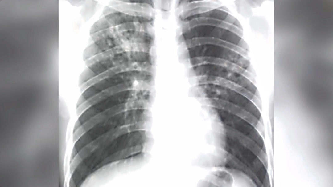 警惕!江苏师大通报22名学生患肺结核:另有43名学生隔离观察