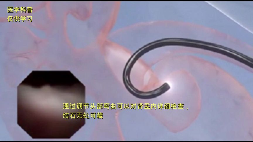 输尿管软镜长什么样。输尿管软镜主要是通过人体自然腔道尿道