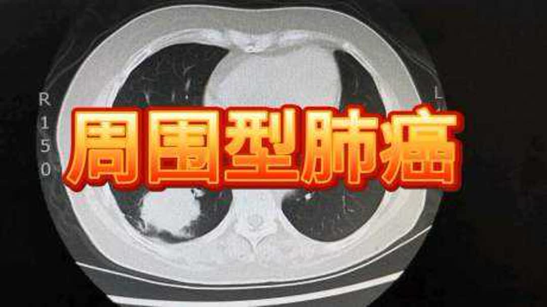 周围型肺癌常见的CT表现