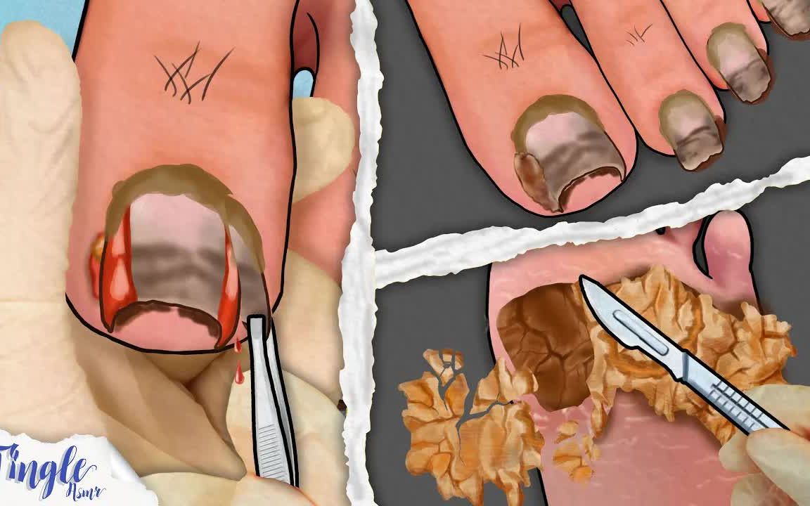 【沉浸式修脚】脚趾甲治疗与脚底死皮清洁护理动画