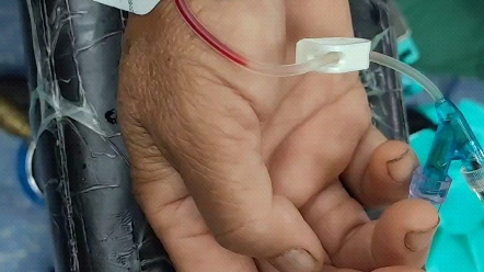 关于我第一次穿动脉置管测压成功