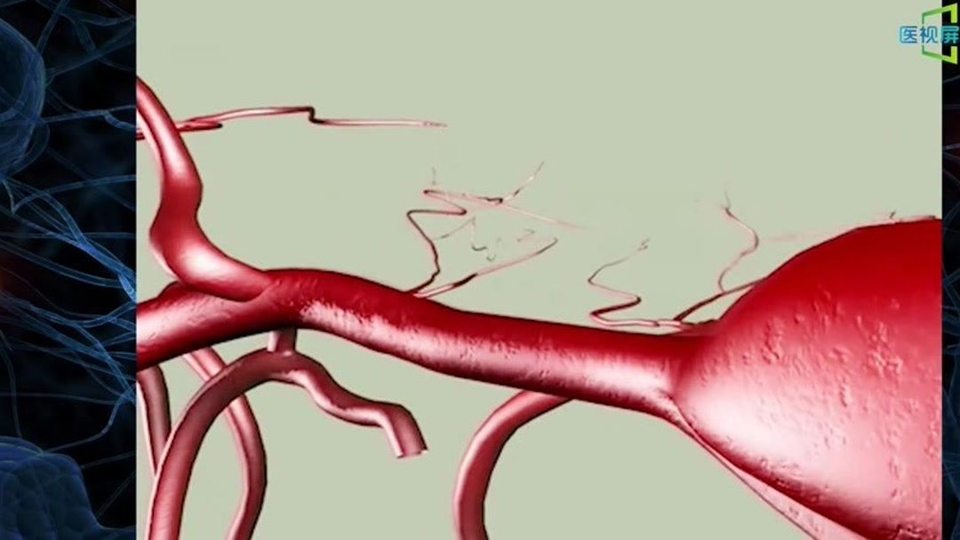 医视屏-准分子激光辅助下非阻塞血管吻合术