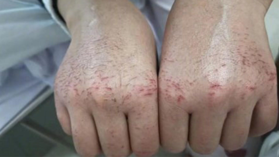 心疼!这是湖南省儿童医院22岁感染科护士的双手 向一线人员致敬