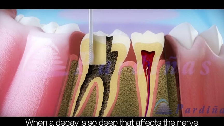 蛀牙治疗,根管治疗术