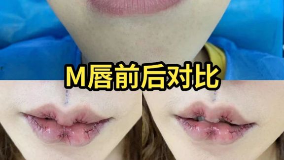 漂亮的嘴唇ߑ�,才配得上男朋友更爱你,M微笑唇术后样子