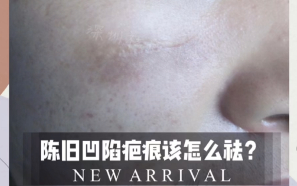 陈年凹陷疤痕该怎么修复?