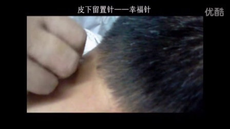 无痛皮下留置针疗法治疗局部痛点——椎枕部痛点的局部疏拨治疗