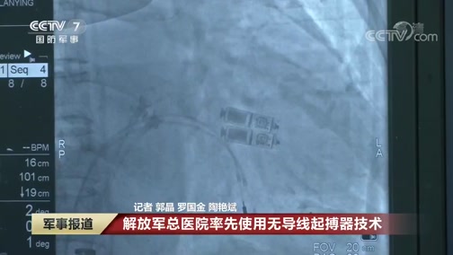 [军事报道]解放军总医院率先使用无导线起搏器技术