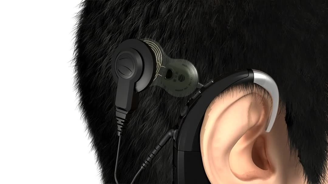 诺尔康人工耳蜗原理介绍