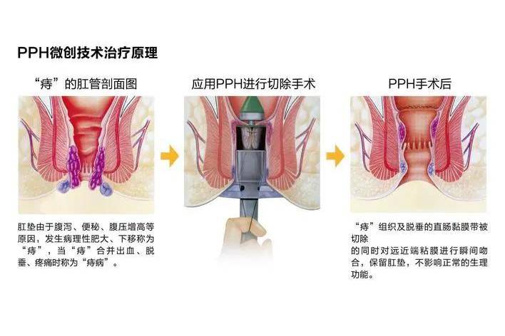 3D动画演示,吻合器痔疮切除术。