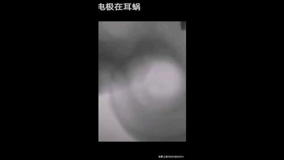 人工耳蜗的电极片在手术中植入的过程