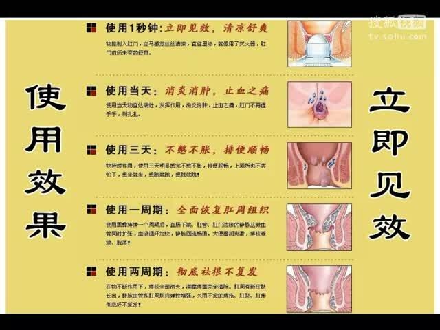 怀孕得痔疮治愈?痔疮怎么按摩消除?痔疮手术后感染?痔疮医院