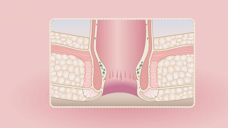 西医说一般人得痔疮可能是这两个原因导致 看看你可能属于哪种?