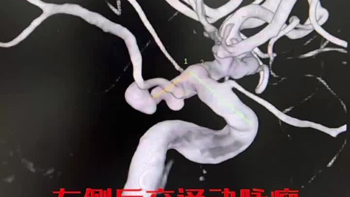 左侧颈内后交通动脉瘤破裂出血,患者入院时已经昏迷