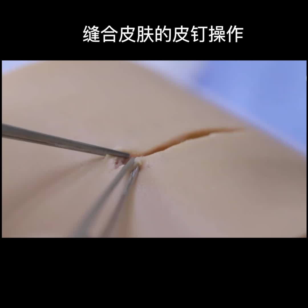 订书机样皮钉缝合皮肤,看到过吗?原理很简单