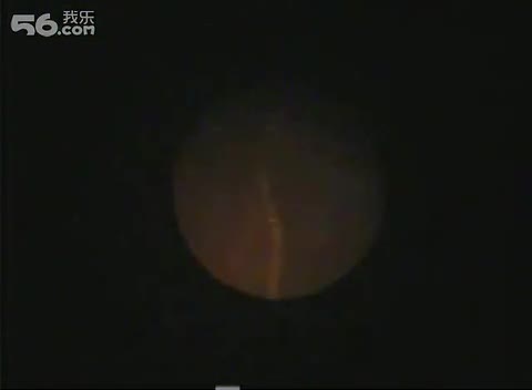 输尿管镜取石术