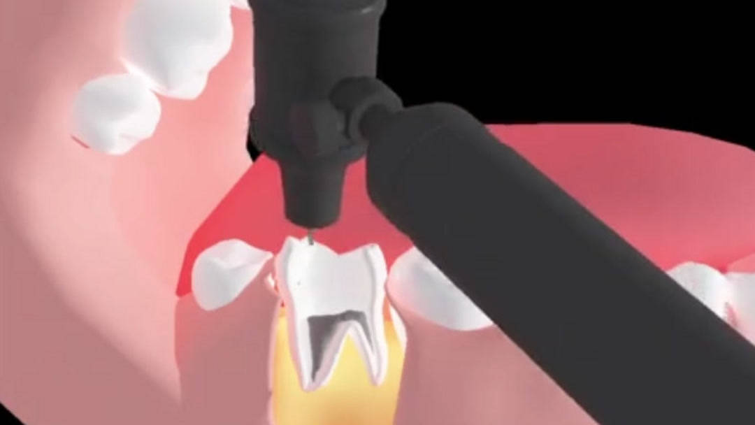 听到声音牙齿都痛!3D模拟根管治疗