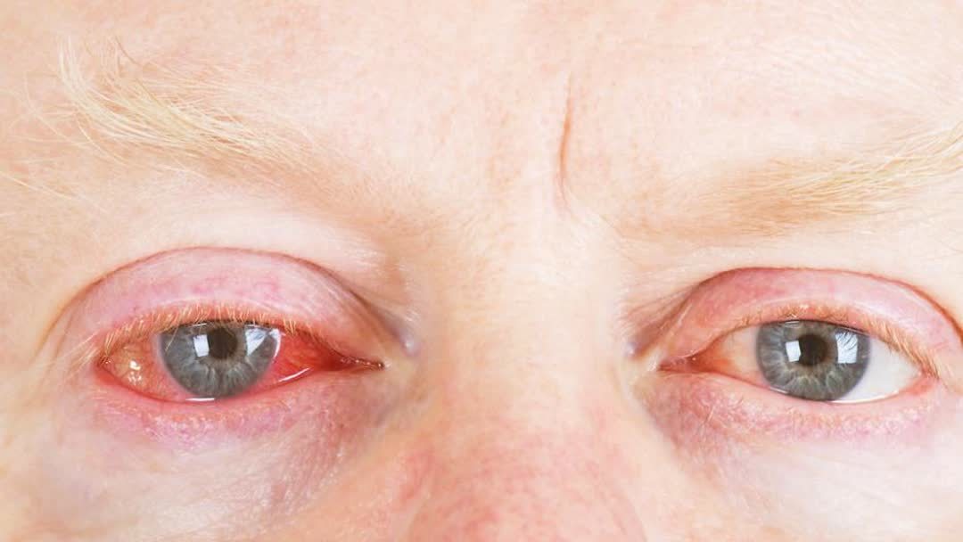 血管堵没堵?身体3个症状很关键,眼睛变化最明显,看一眼全明白