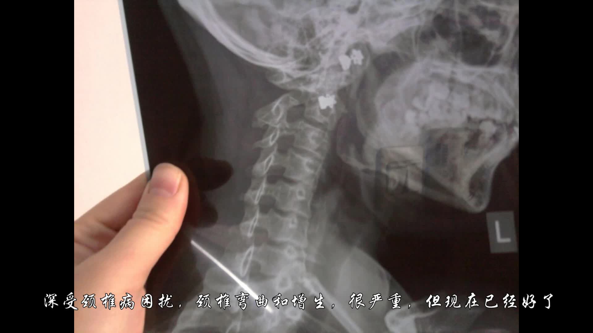 颈椎病的症状,颈椎病引起的头晕如何治疗方法,4个方法让你从容