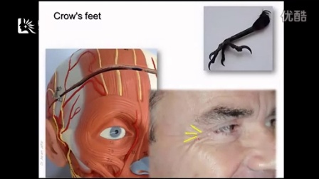 皱纹和肉毒杆菌毒素注射