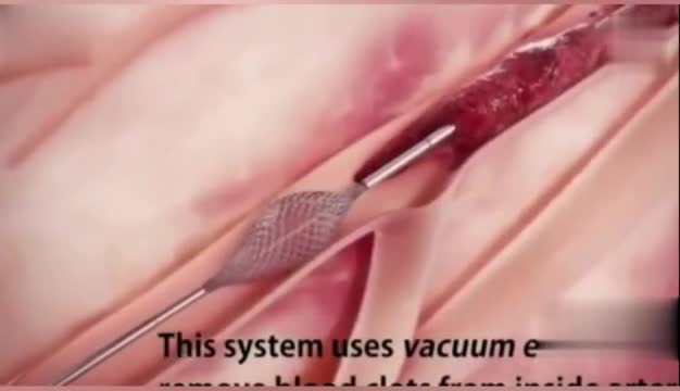 机器是如何去除血管壁的胆固醇的?一个动画为你揭秘