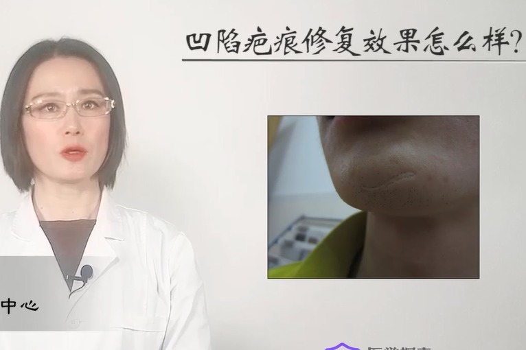 上海疤痕医院上海长江医院肖萍:凹陷疤痕修复效果怎么样?