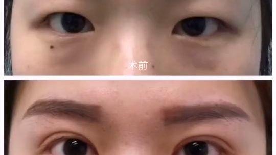泡泡眼李氏眶隔法双眼皮及李氏z字法内眼角成形术后5月复查