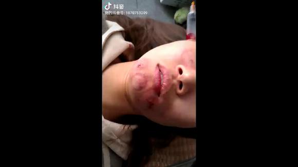 火针拔血罐治疗青春痘痤疮的临床效果!