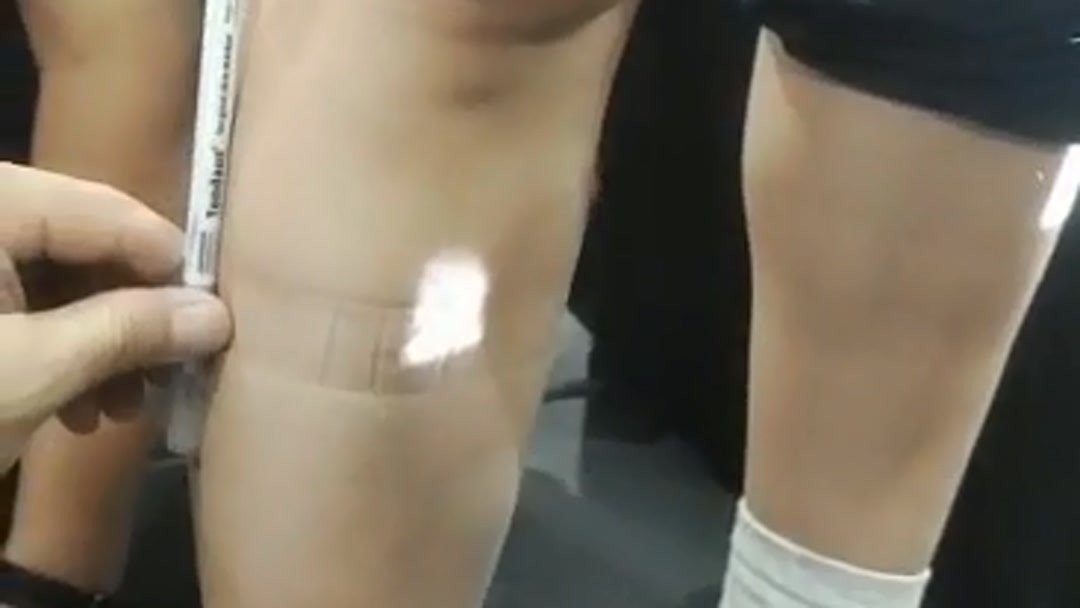 吴士杰吴氏无痛一针疗法——“上臂抬举无力”一针速效