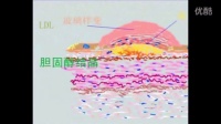 动脉粥样硬化的病因及发病机制
