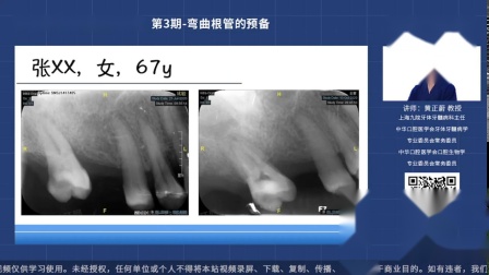 黄正尉 弯曲根管的预备03