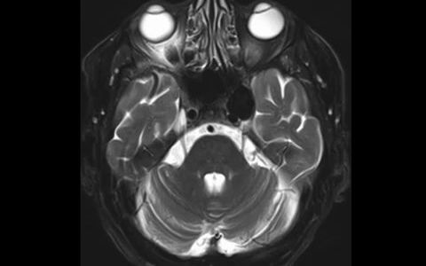 091Cavernous Carotid Aneurysms(颈内动脉海绵窦段动脉瘤)