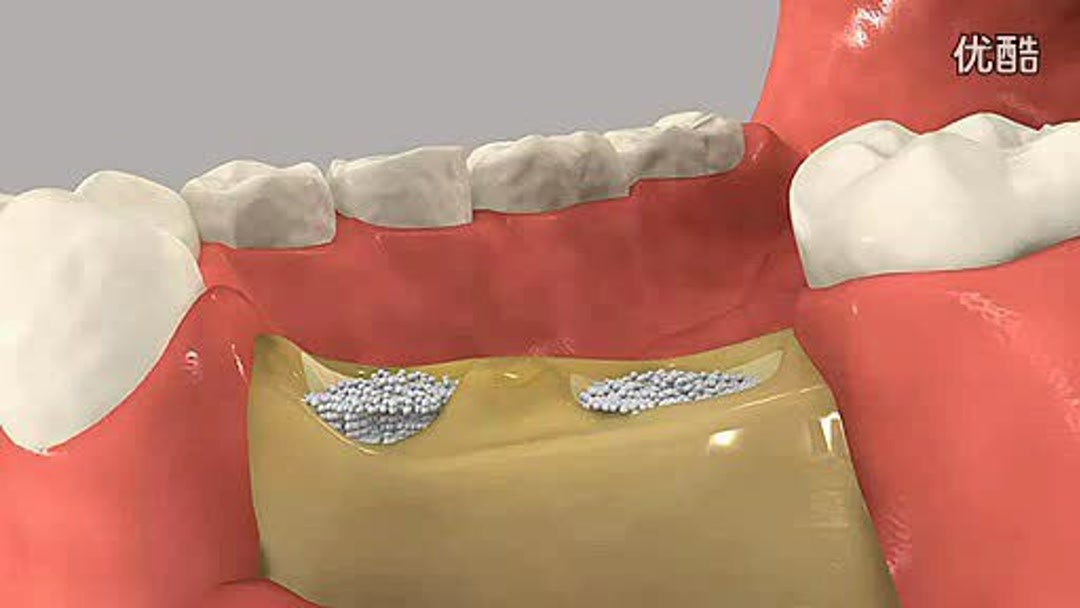 什么是牙槽骨再生术 口腔医患沟通3D动画素材_标清