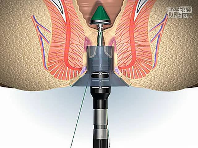 一次性痔疮吻合器-PPH技术动画